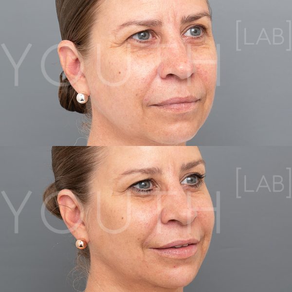 Liquid Face Lift (8 Point Lift) - Youth Lab, Perth