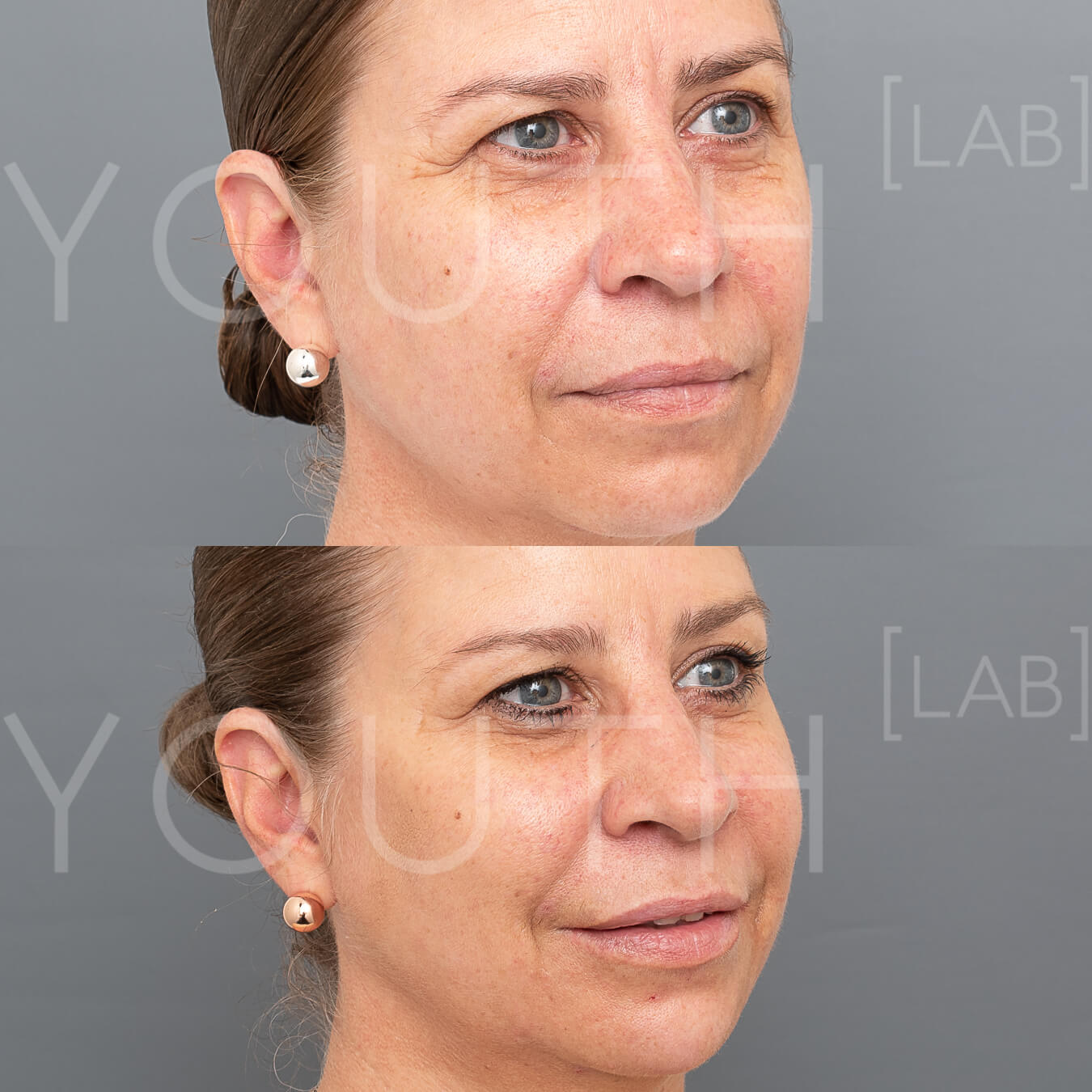 Liquid Face Lift Perth (8 Point Lift) - Youth Lab