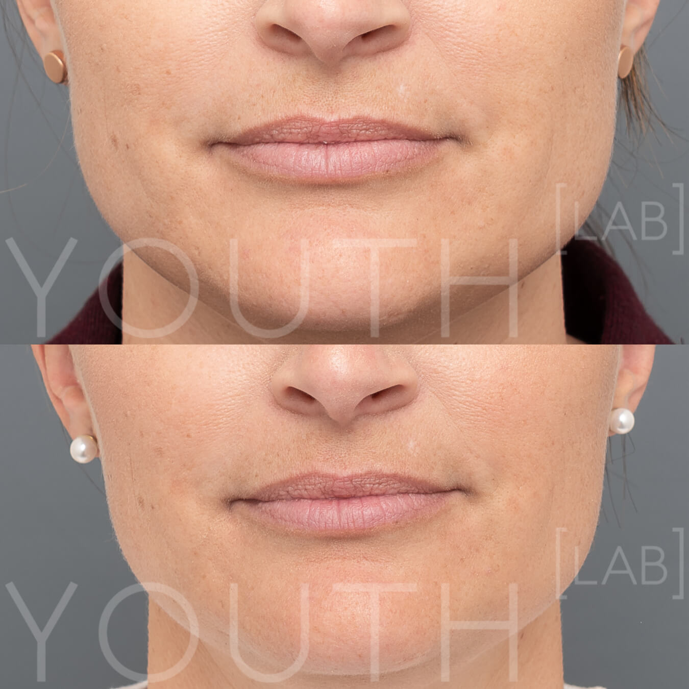 Masseter Reduction Perth - Jawline Slimming - Youth Lab
