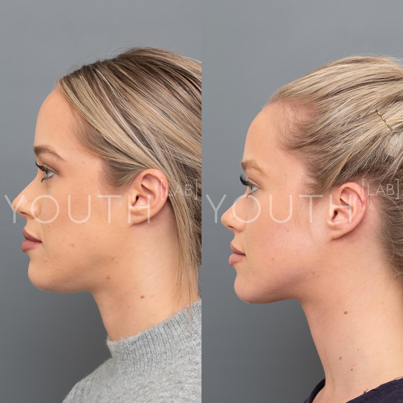 Fat Dissolving Injections Perth - Youth Lab