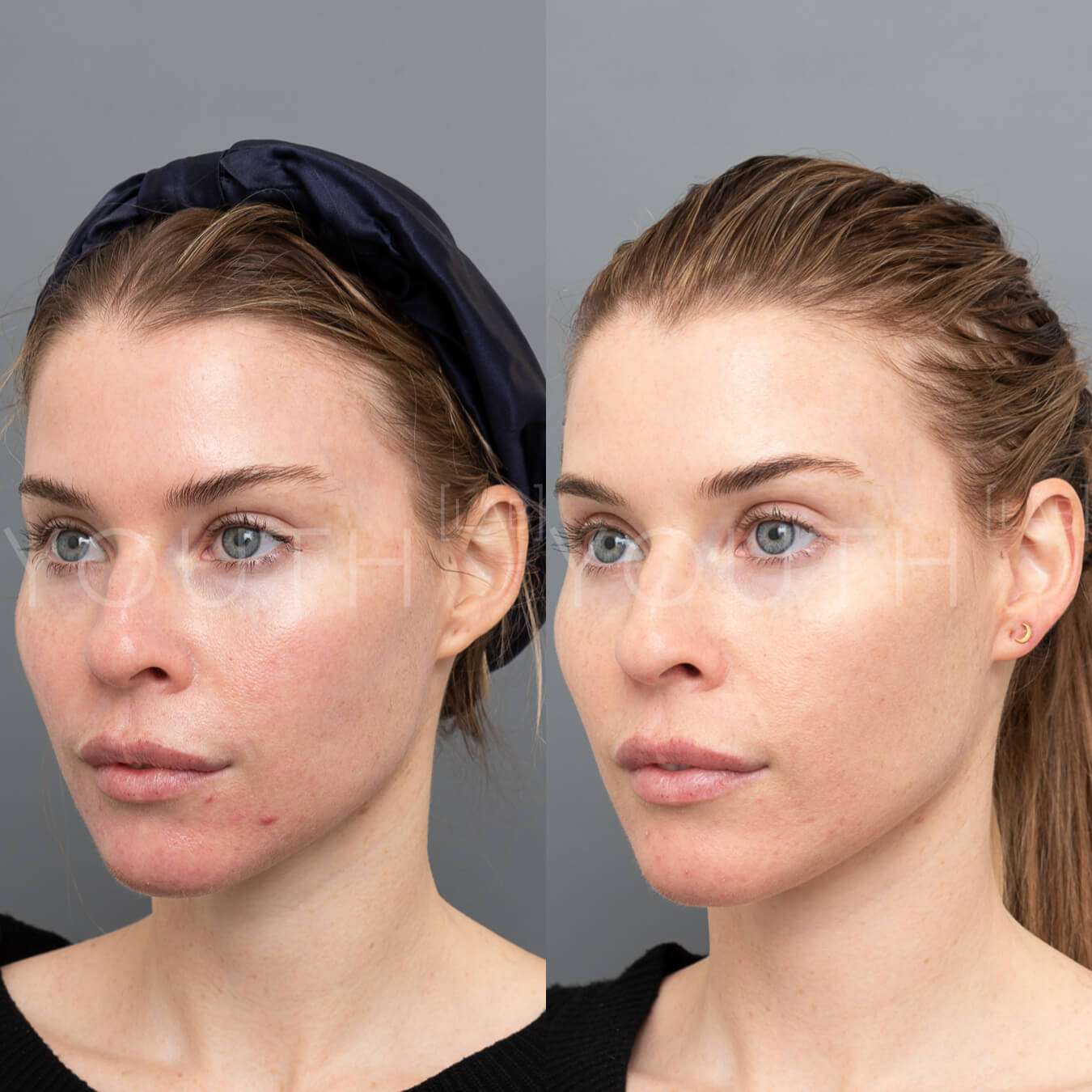 Halo Fractionated Laser Resurfacing Perth - Youth Lab