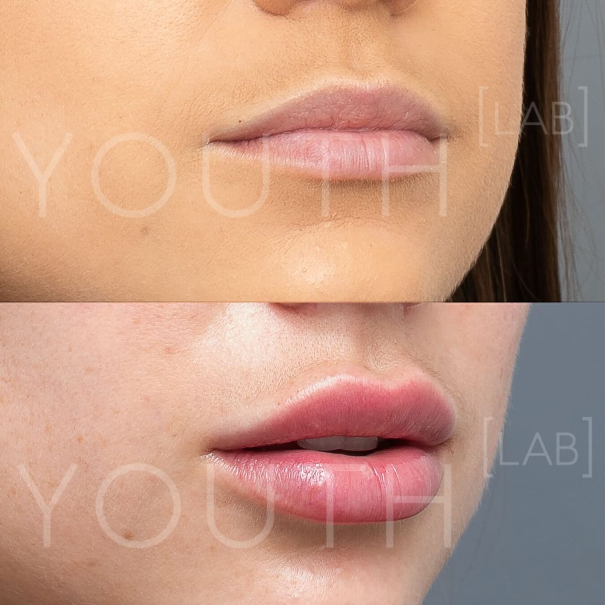 Lip Fillers Perth - Perth's #1 Injectors - Youth Lab